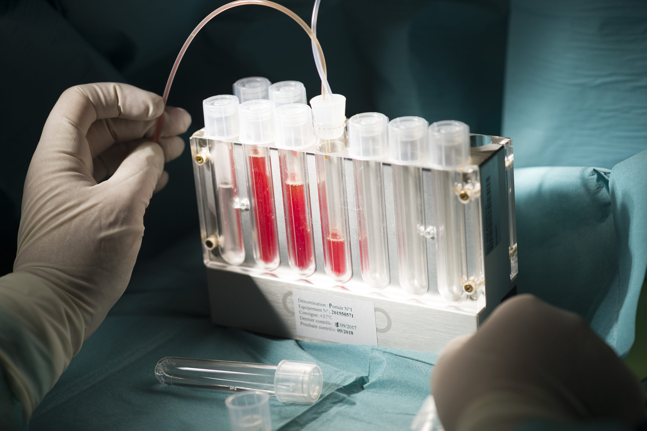 A new dual-channel needle for the extraction of oocytes during the IVF ...