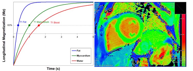 ShMOLLI: Shortened Modified Look-Locker Inversion Recovery, for T1 mapping in cardiovascular MRI ...